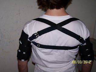 Shoulder Subluxation After Stroke