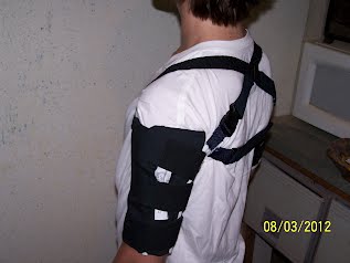 Shoulder Subluxation After Stroke